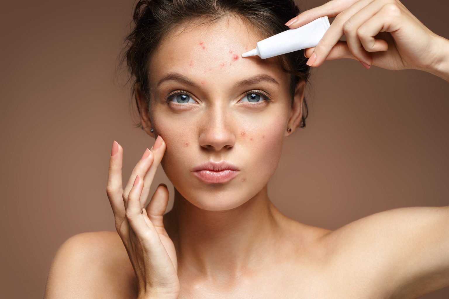 7 Causes Of Adult Acne And Ways To Treat It